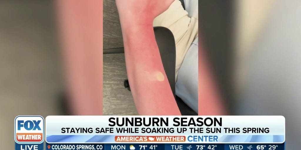 Sunburn season: Staying safe while soaking up the sun this spring ...
