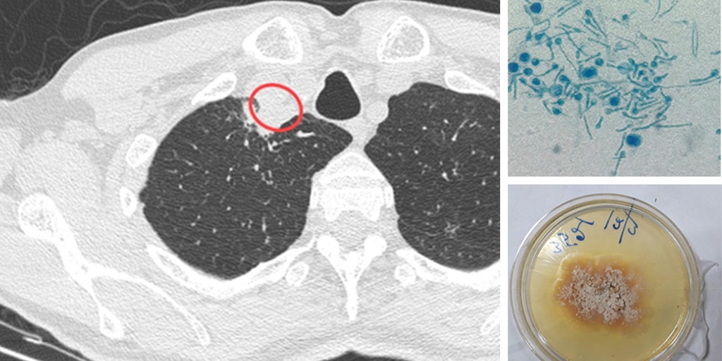 Deadly plant fungus infects man in first-known global case, doctors say ...